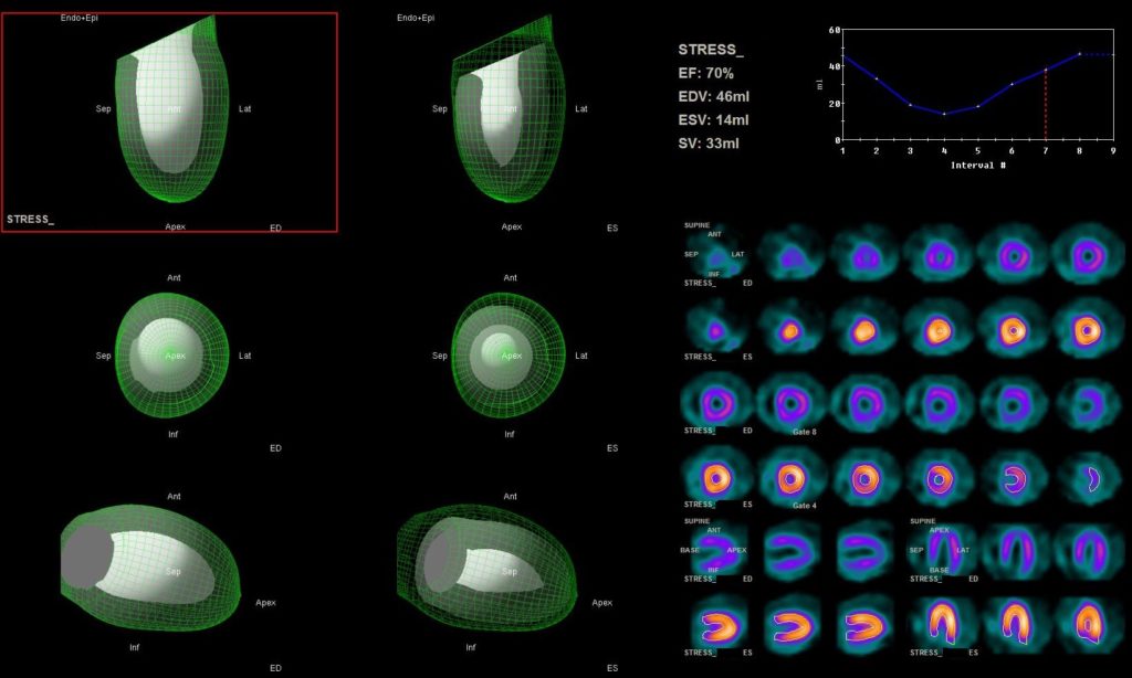 SPECT/CT Հետազոտություն